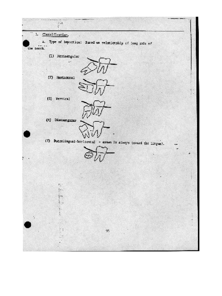 Impaction Classifications | PDF