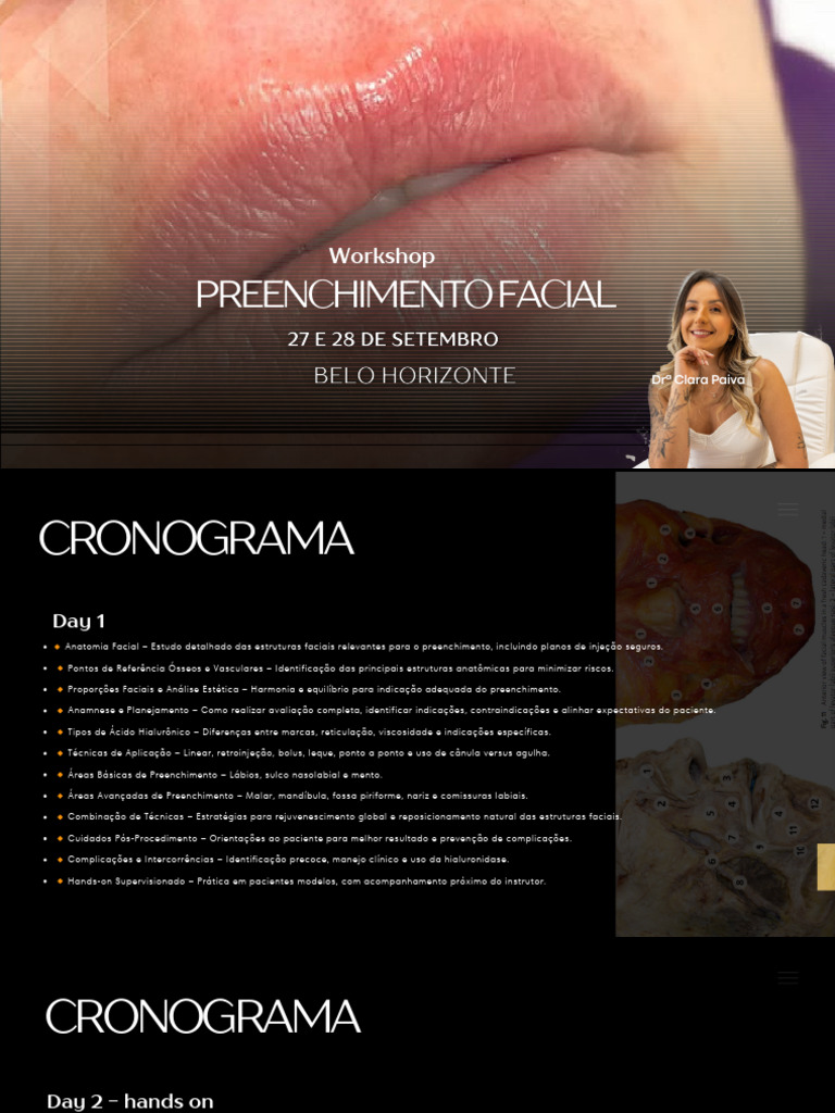 Workshop de Preenchimento Facial Avançado | PDF