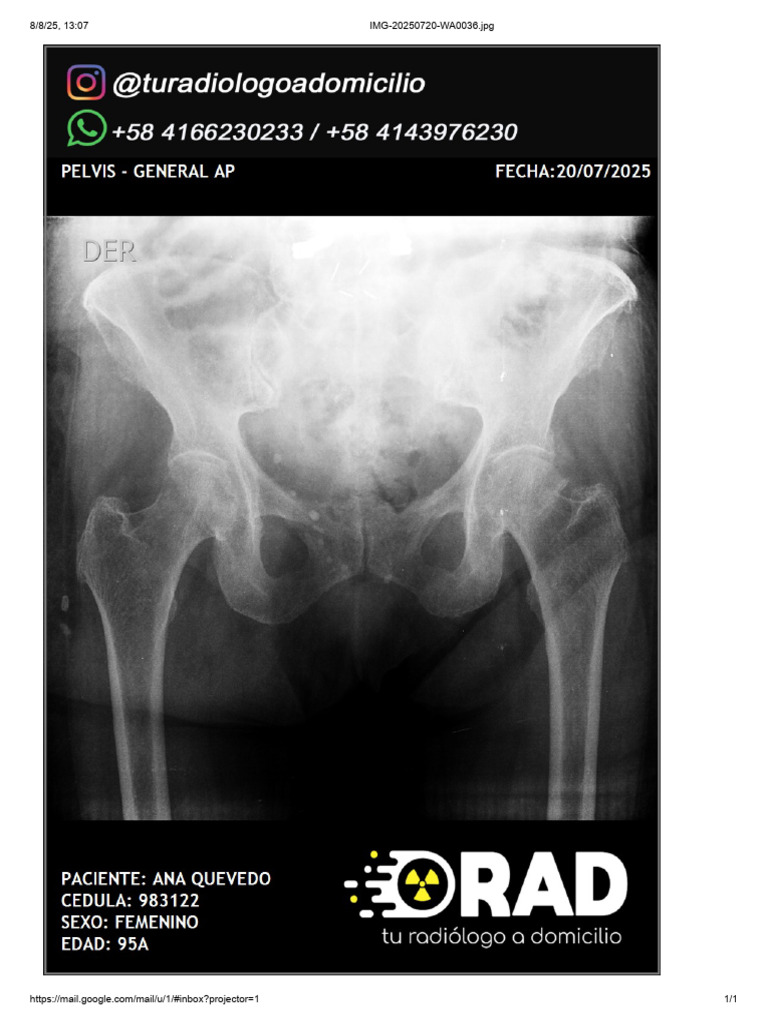 Placa de Rx. de Fractura de Pelvis General AP Derecha de Ana Cristina ...