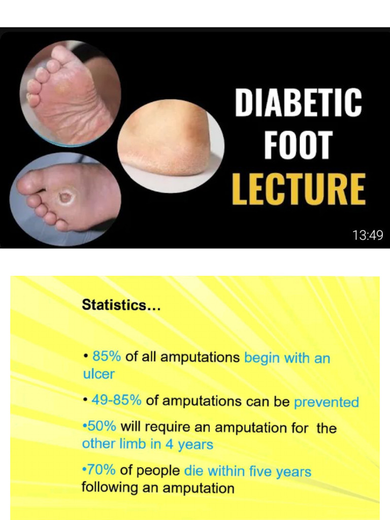 Diabetic Foot Disease | PDF