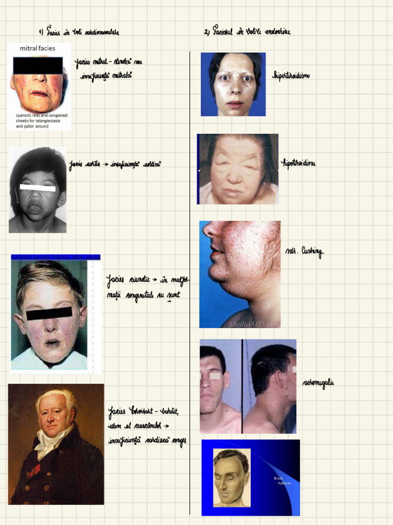 Corvisart Facies in Cardiovascular Conditions | PDF