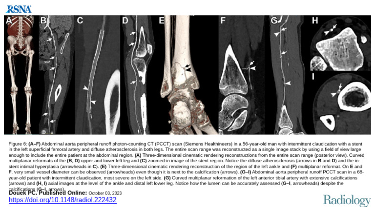 Abdominal Aorta PCCT Scan Analysis | PDF