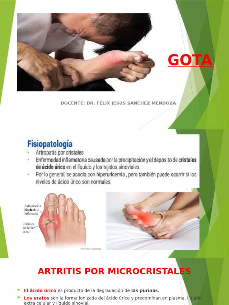Artritis por Microcristales y Gota | PDF | Gota | Droga anti ...