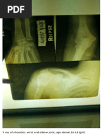 Bone Age Specific X-Rays | PDF