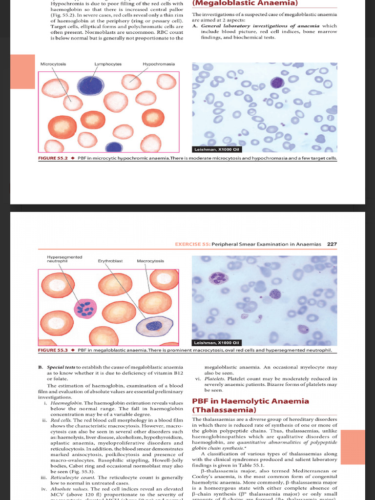 2nd Year MBBS: Anaemia Study Resources | PDF | Anemia | Medical Specialties