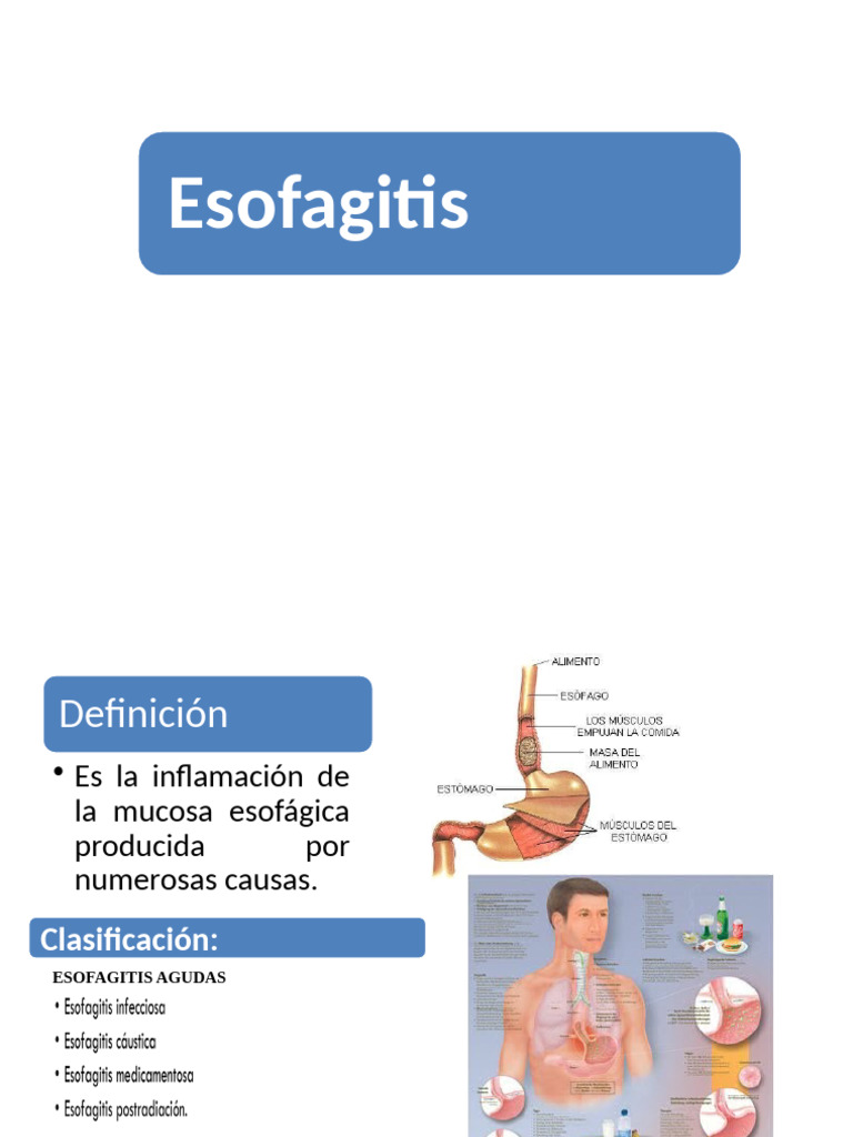 Clasificación y causas de esofagitis | PDF | La enfermedad por reflujo ...