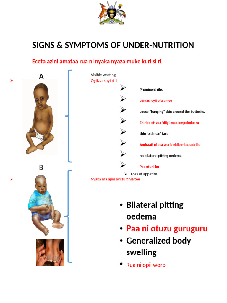 Signs and Symptoms of Under-Nutrition | PDF