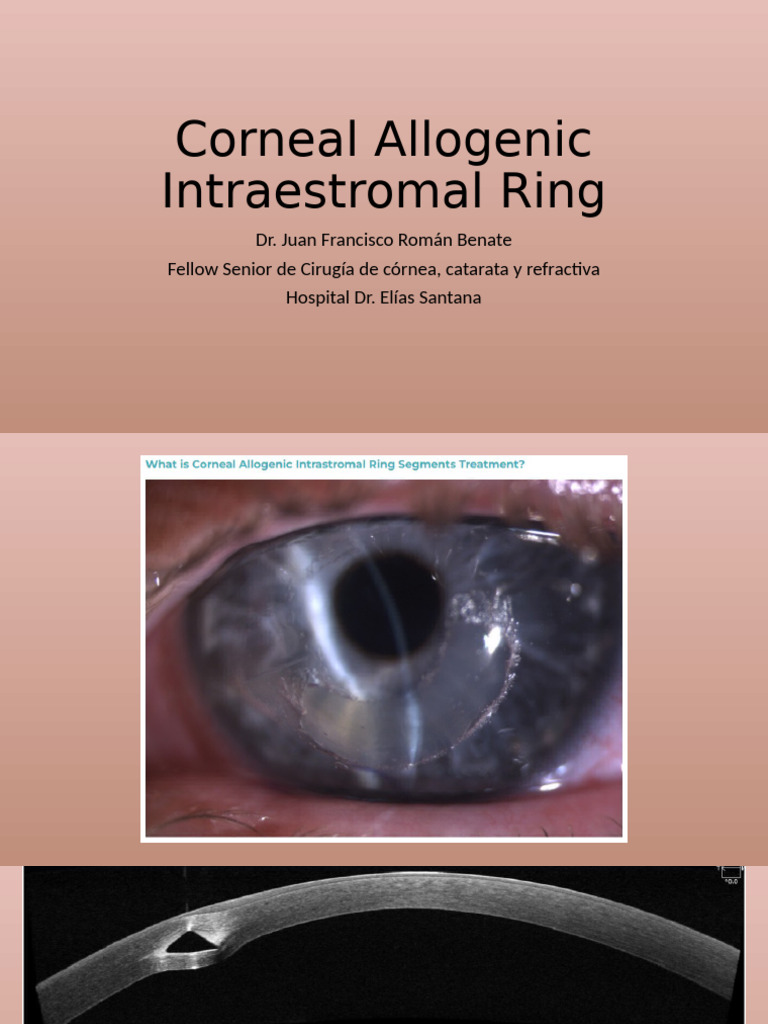 01 Corneal Allogenic Intraestromal Ring | PDF