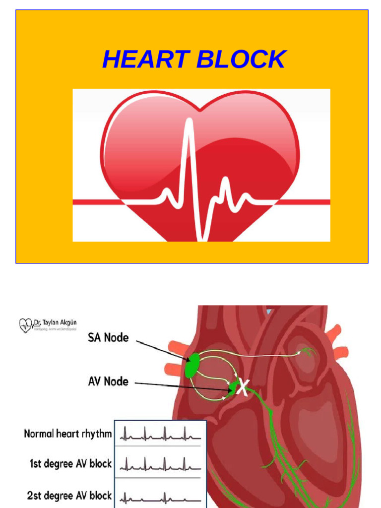 Understanding Heart Block Types and Causes | PDF | Electrocardiography ...
