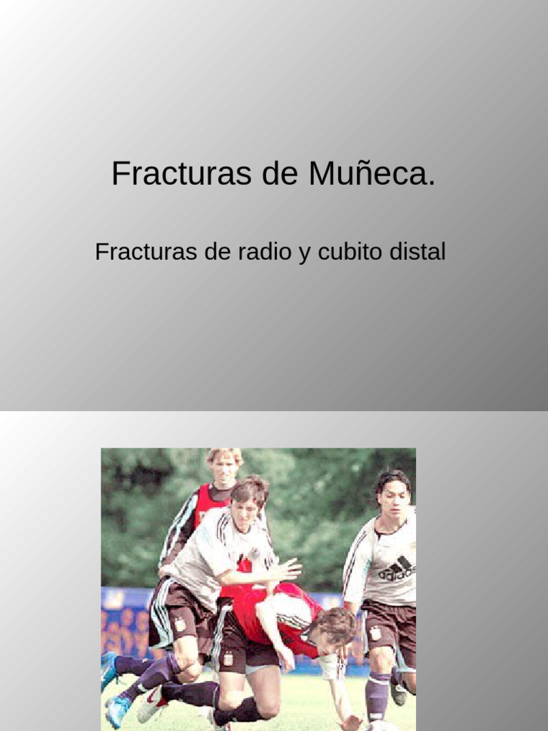 Explicación de La Fractura de La Muñeca | PDF