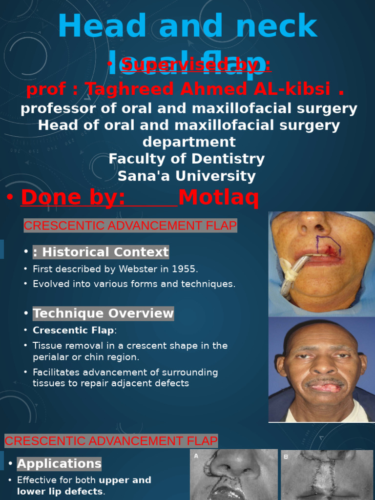 Crescentic Advancement Flap Techniques | PDF | Human Nose | Surgery