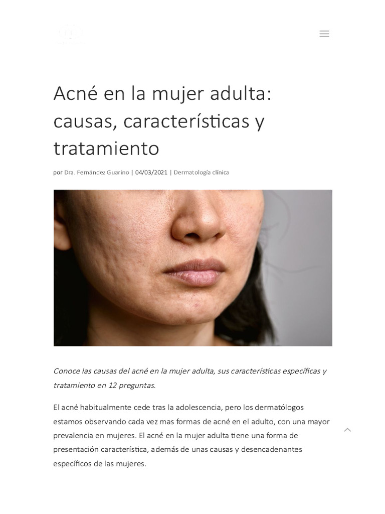 Acné en mujeres adultas: causas y tratamiento | PDF | Dermatología ...