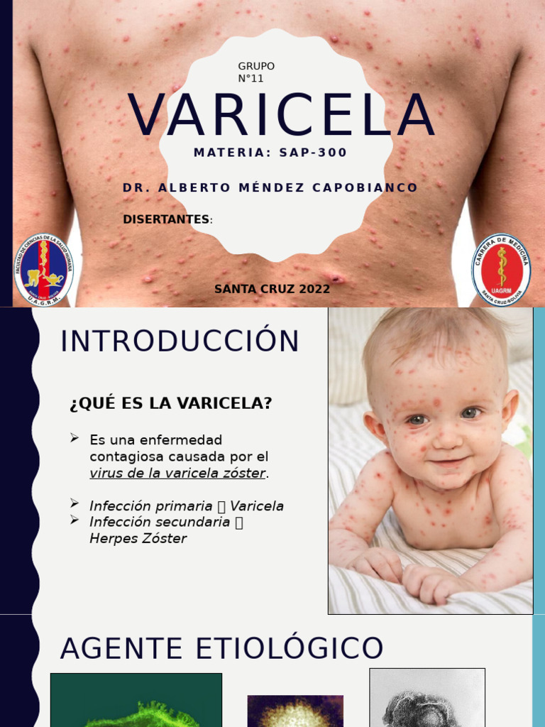 Varicela | PDF