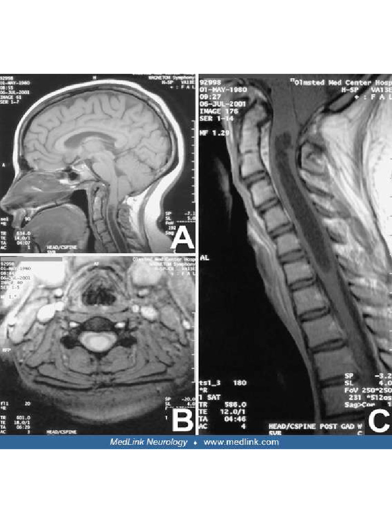 Primary Cough Headache - MRI | PDF