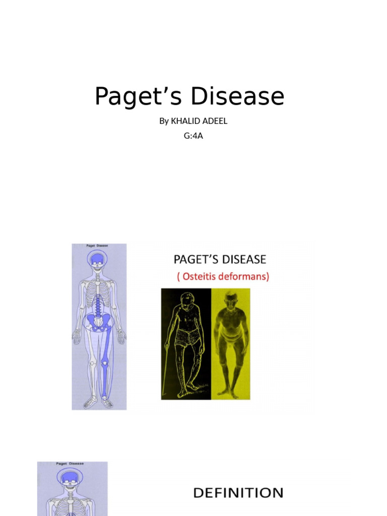 Paget's Disease | PDF