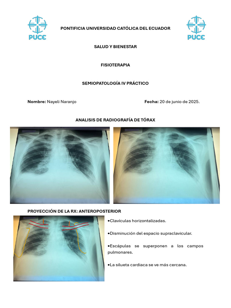 Análisis de RX de Tórax | PDF | Tórax | Tórax (anatomía humana)