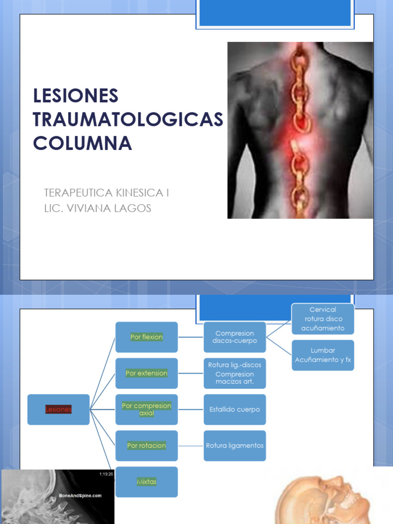Lesiones Traumáticas de la Columna y Tratamiento | PDF | Sistema ...