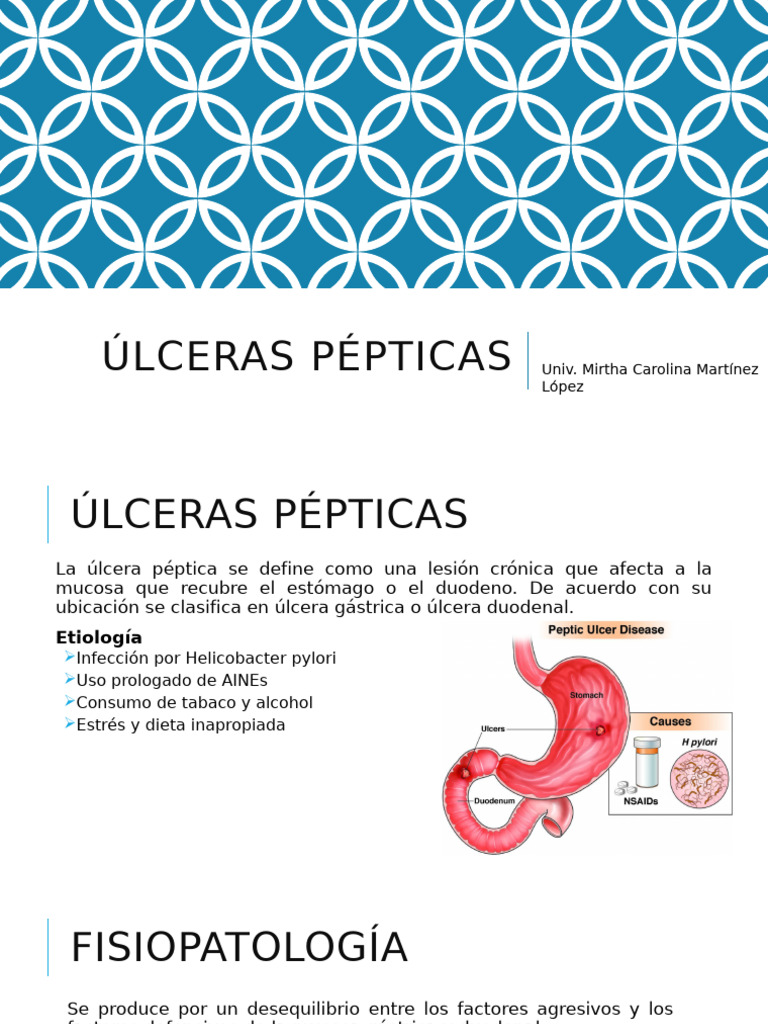 Causas y Tratamientos de Úlceras Pépticas | PDF