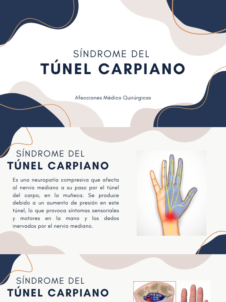 Sindrome Del Tunel Carpiano | PDF | Enfermedades y trastornos ...