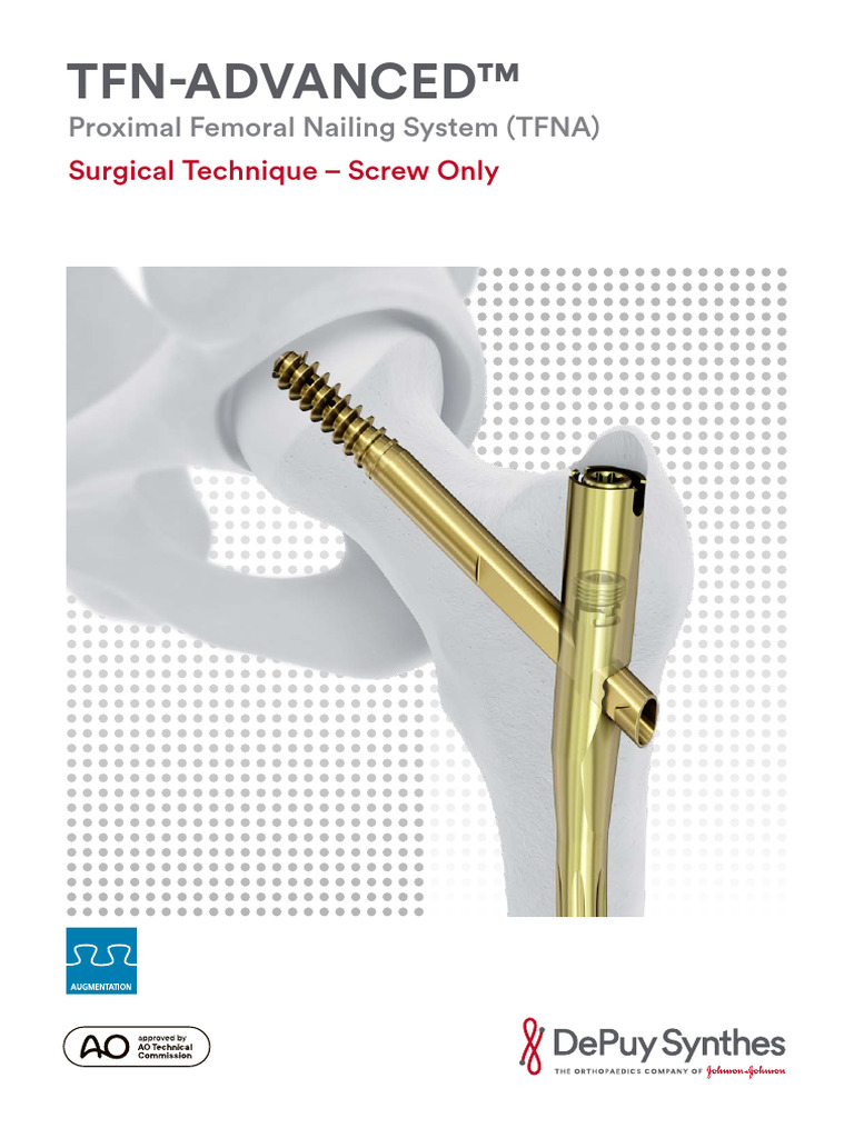 TFN-ADVANCED™ Surgical Technique Guide | PDF | Screw | Implant (Medicine)
