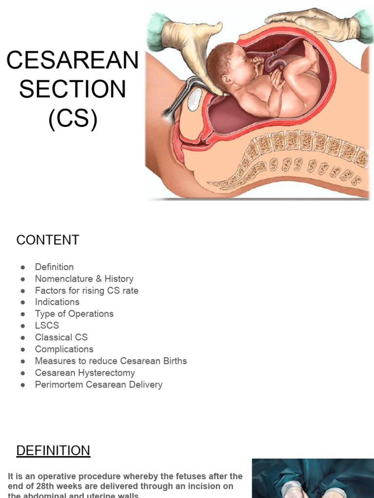 Caesarean Section (C-Section) | PDF | Caesarean Section | Childbirth