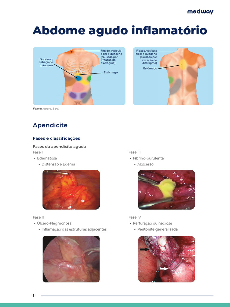 Classificações e Tratamentos de Apendicite | PDF | Doenças digestivas ...