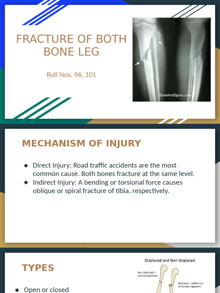 Fracture of Both Bone Leg | PDF | Knee | Clinical Medicine