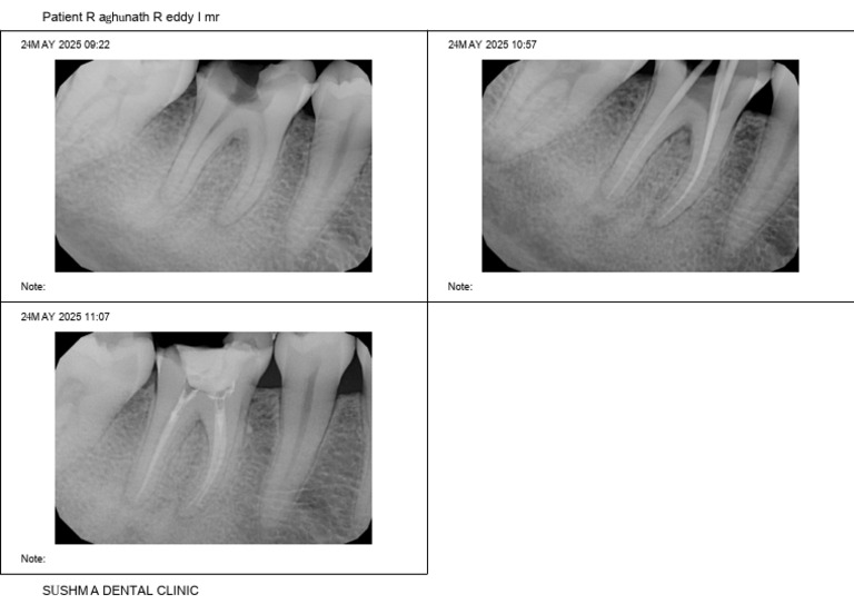 Root Canal X Ray | PDF