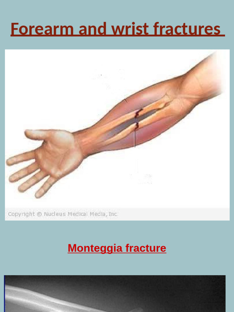 Upper Limb Fractures (FOREARM & WRIST) | PDF | Elbow | Musculoskeletal ...