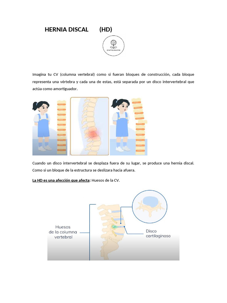 HD Hernia Discal | PDF
