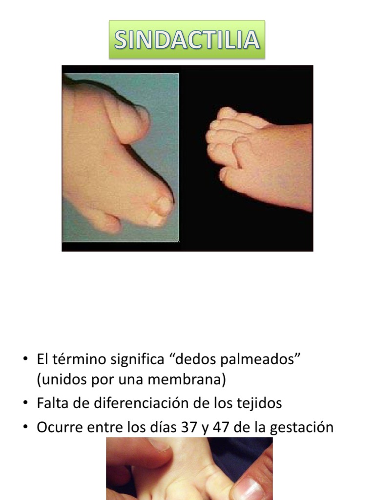 Sindactilia y Polidactilia | Mano | Sistema musculoesquelético