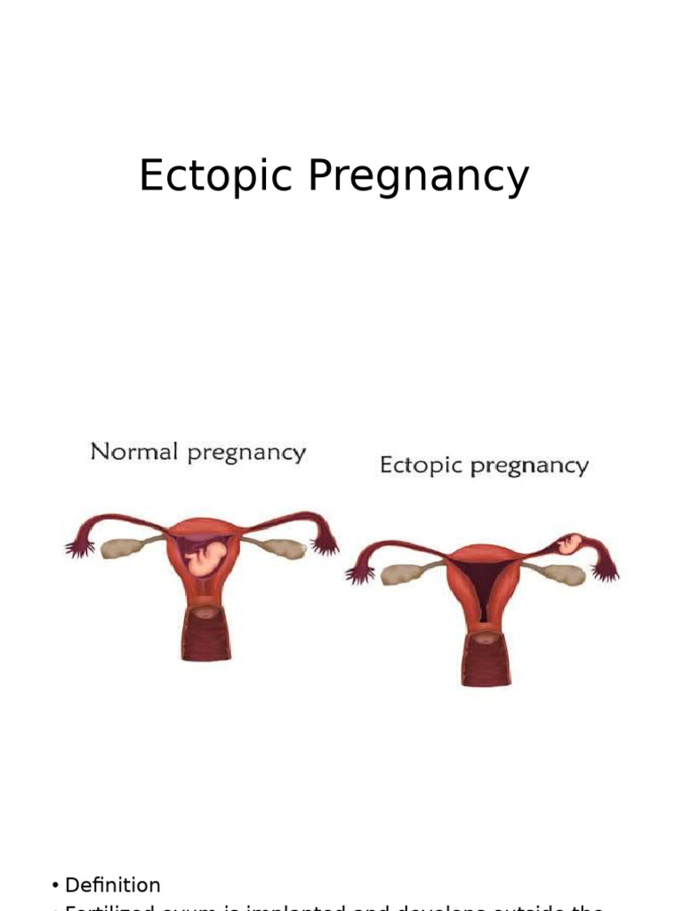 Ectopic Pregnancy | PDF