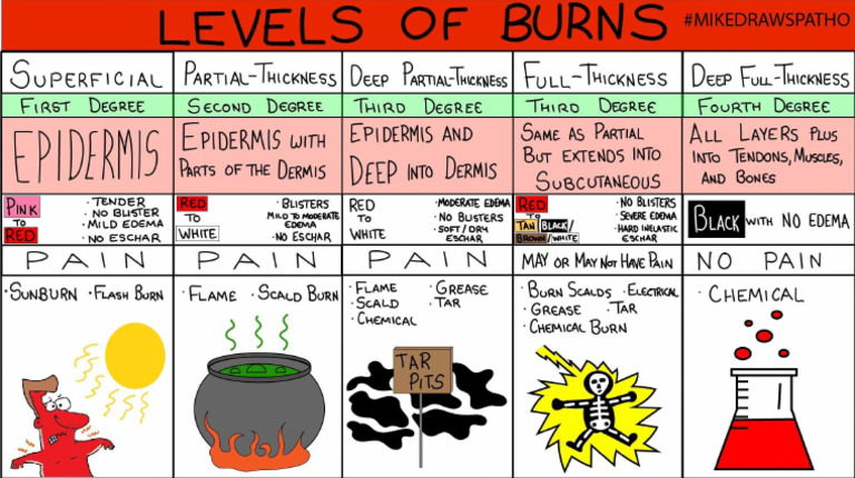 Levels of Burns Skin Burns Wounds | PDF