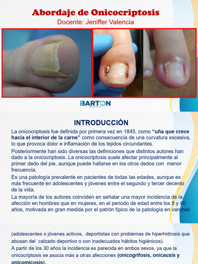 Guía Completa sobre Onicocriptosis | PDF | Clavo (anatomía ...