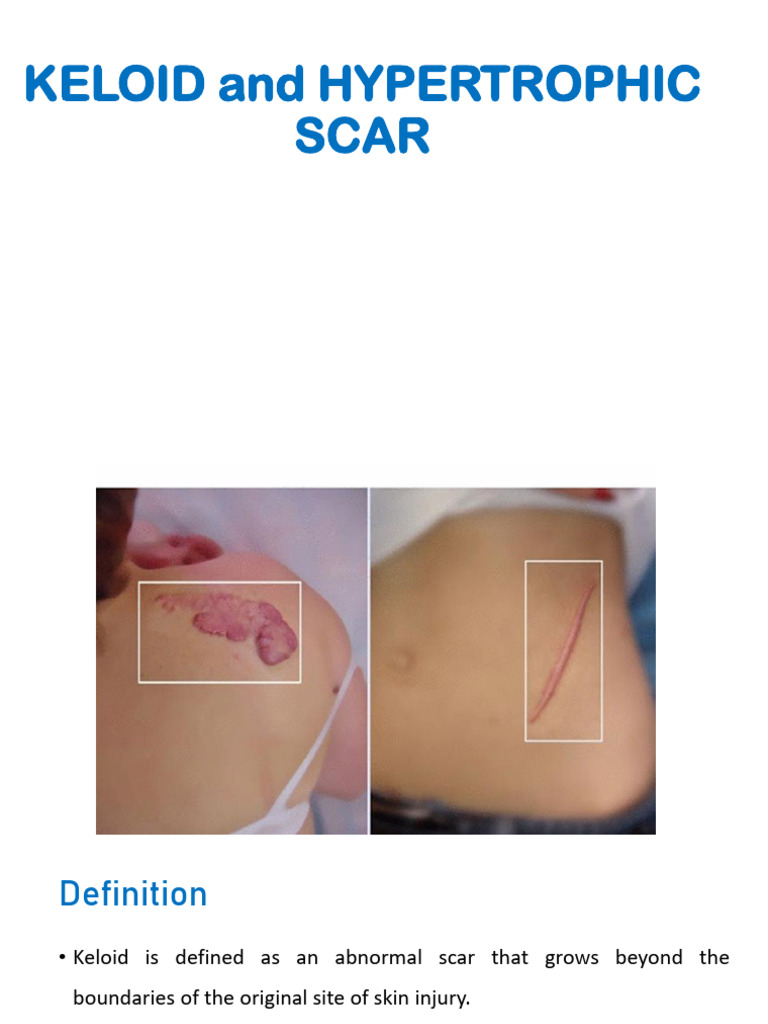 Keloid | PDF | Scar | Wound Healing