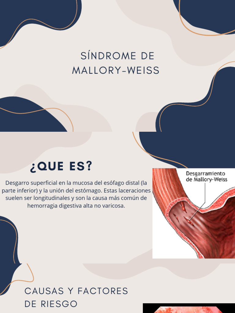 Síndrome de Mallory-Weiss: Causas y Tratamiento | PDF