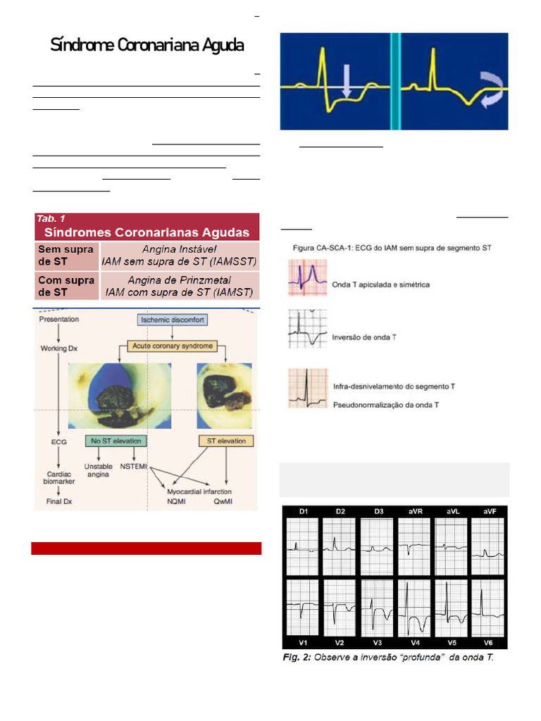 Síndrome Coronariana Aguda: Diagnóstico e Manejo | PDF | Infarto do ...