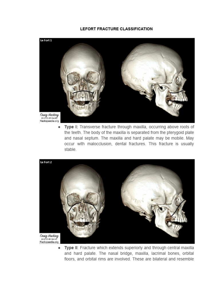 Lefort Fracture Classification Overview | PDF