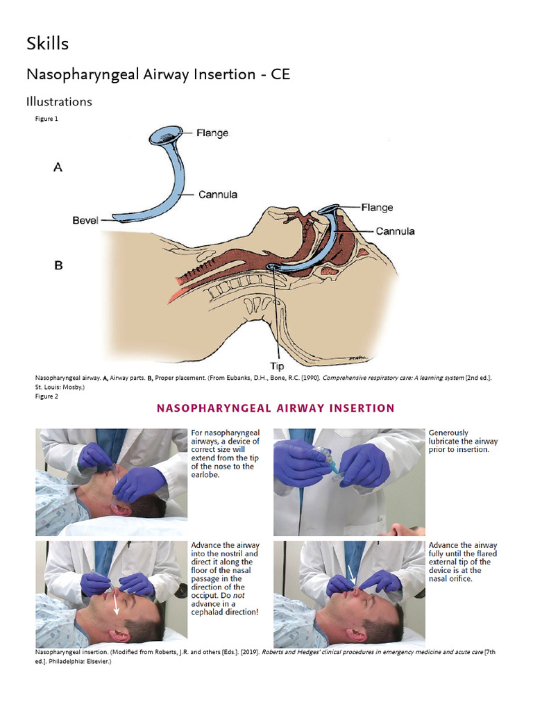 Nasopharyngeal Airway Insertion Guide | PDF