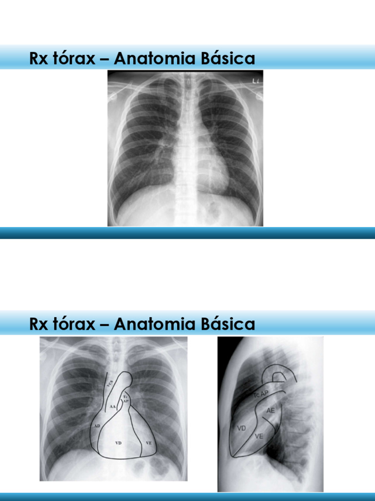 Avaliação de Rx de Tórax: Anatomia e Casos | PDF | Tosse | Doenças e ...