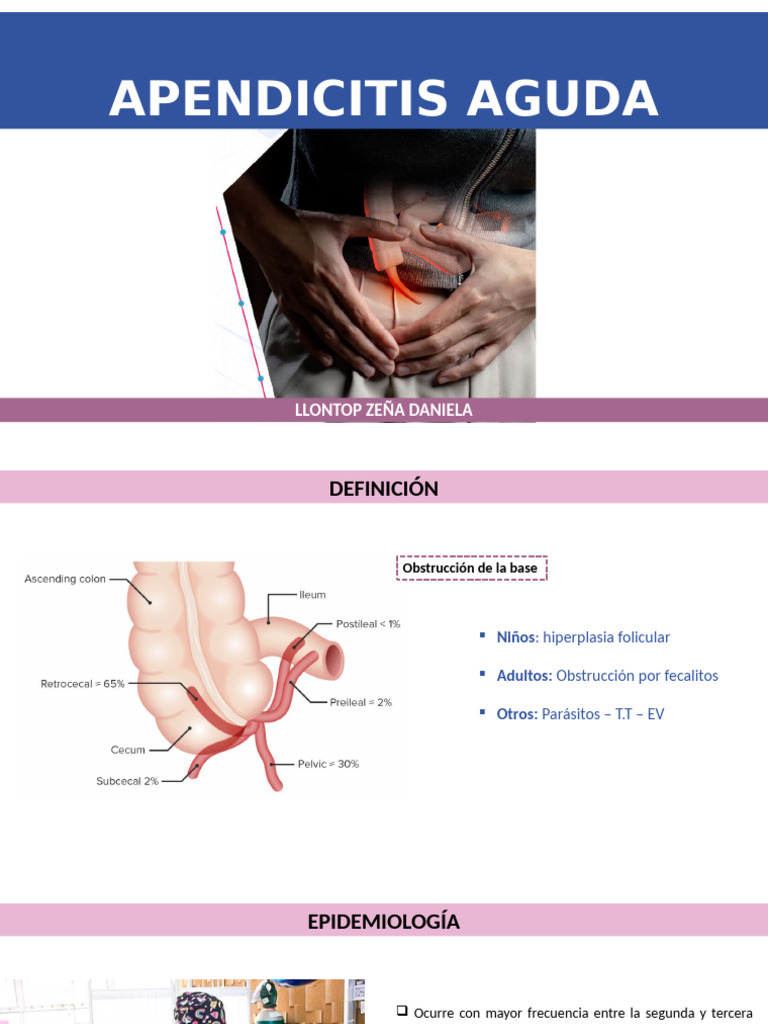 Apendicitis Aguda: Diagnóstico y Tratamiento | PDF | Síntomas y signos ...