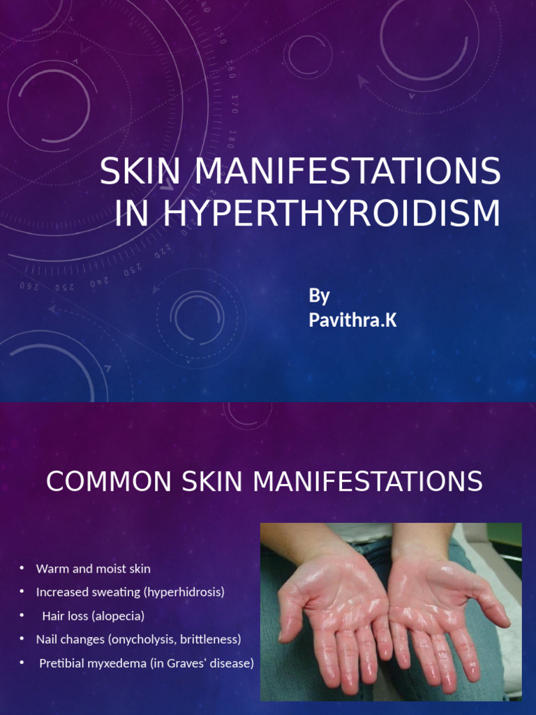 Skin Manifestations in Hyperthyroidism | PDF