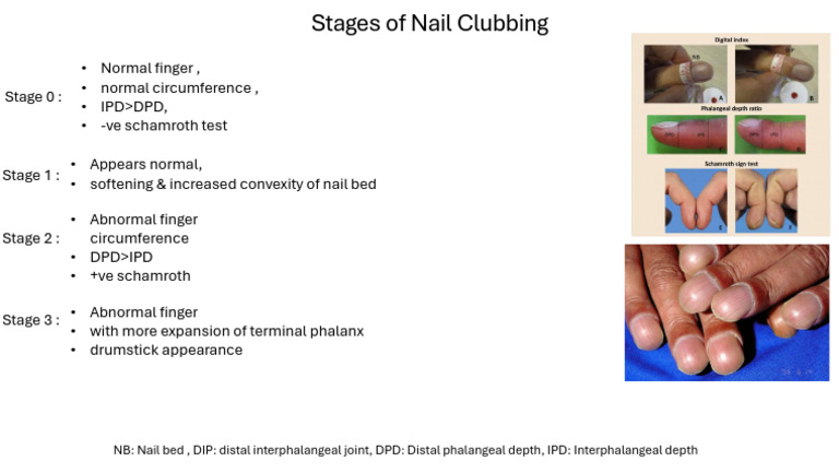 Stages of Nail Clubbing Explained | PDF