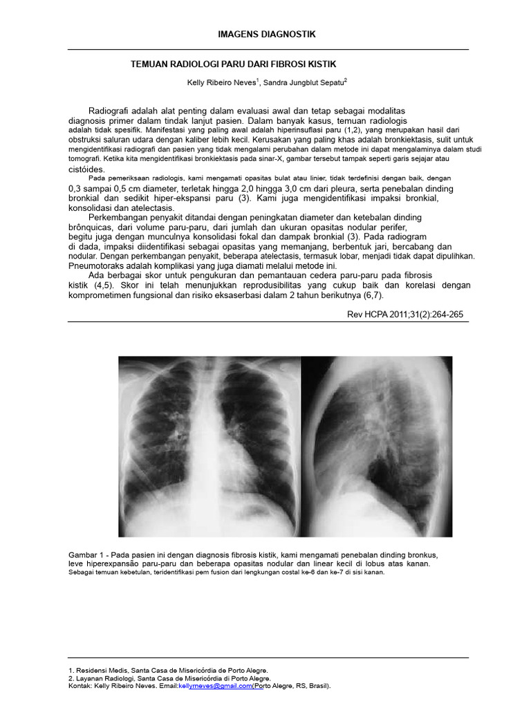 Temuan Radiologi Paru Fibrosis Kistik | PDF
