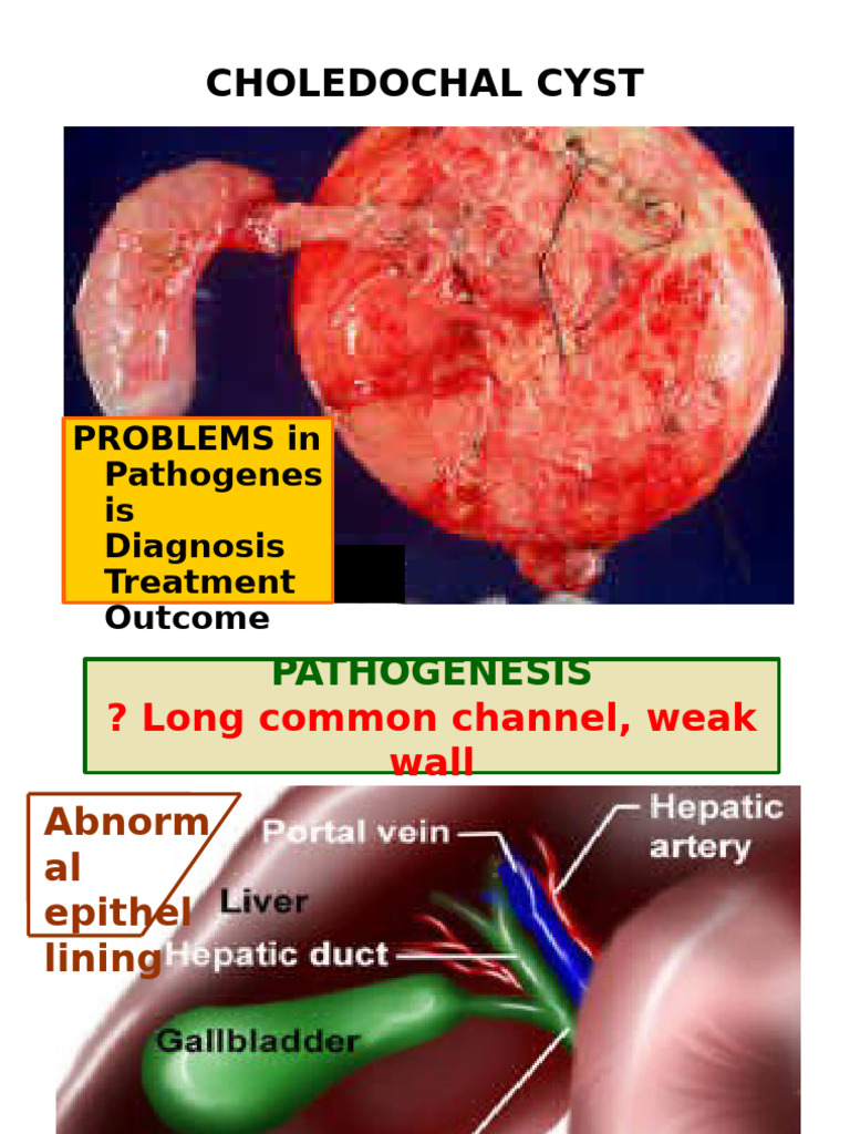 Choledocal Cyst | PDF