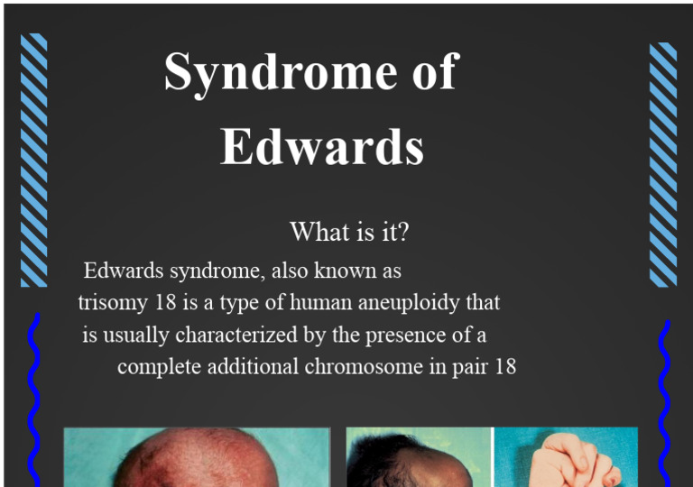 Understanding Edwards Syndrome (Trisomy 18) | PDF