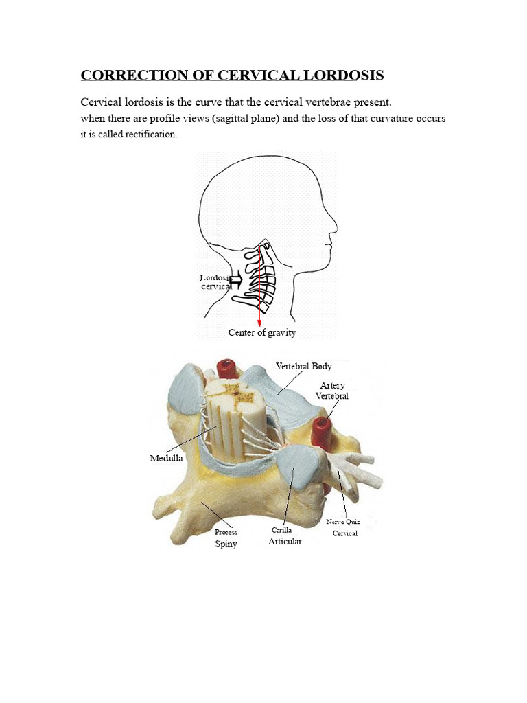 Correction of Cervical Lordosis | PDF | Pain | Spinal Cord