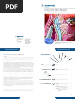 Colloid Cyst (Transcortical Approach) | PDF | Cerebrospinal Fluid ...