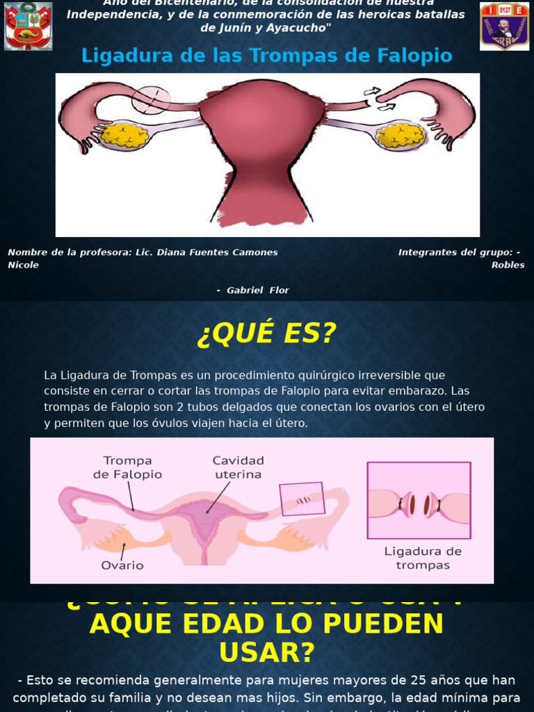 Ligadura de Las Trompas de Falopio D.P.C.C | PDF