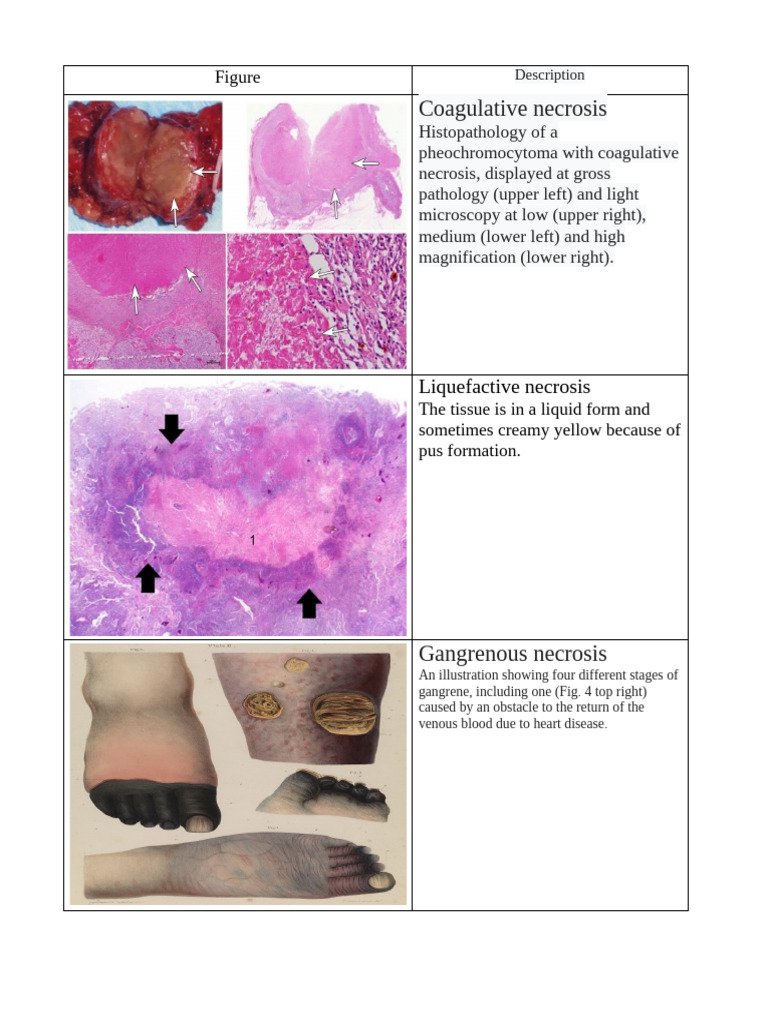 Coagulative and Liquefactive Necrosis Histology | PDF